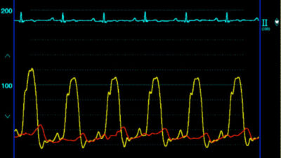 Waveform Interpretation: Left Atrial, Aortic, Peripheral Arteries, Left ...