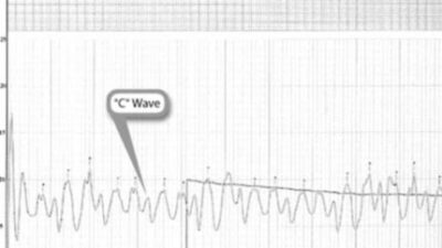 Waveform Interpretation: Right Atrial, Right Ventricular, Pulmonary ...