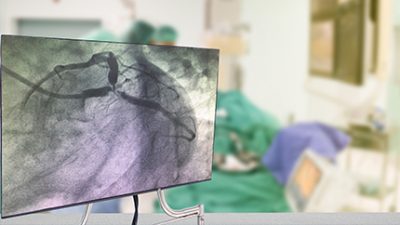 Bypass Graft Angiography Basics – CardioVillage
